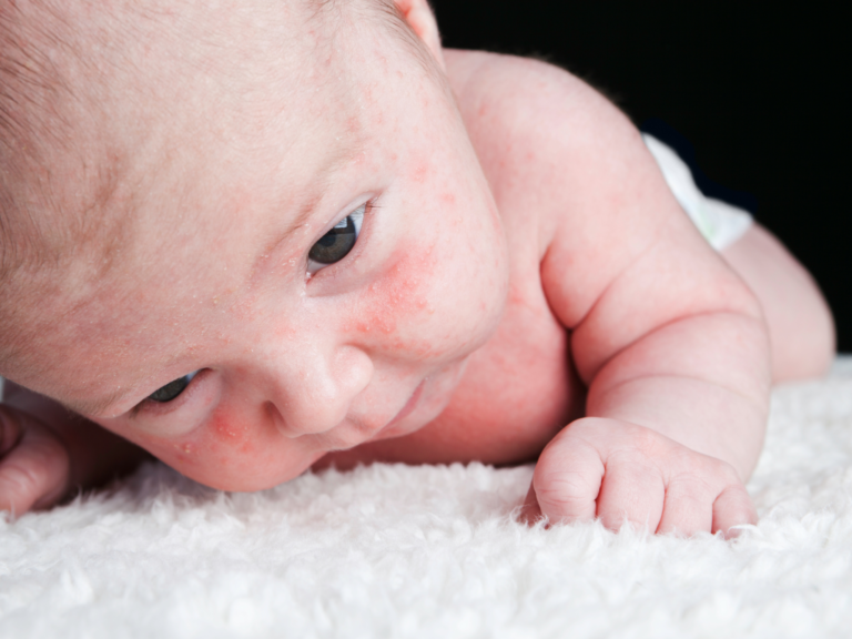 Common Skin Conditions (Infants) – Health Information