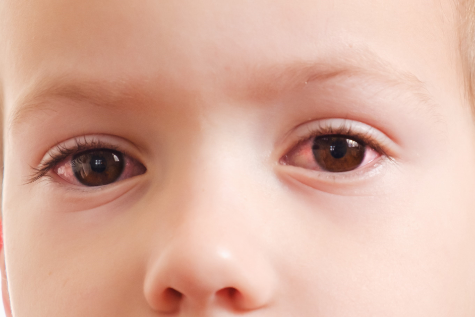 Pinkeye (Conjunctivitis) – Health Information